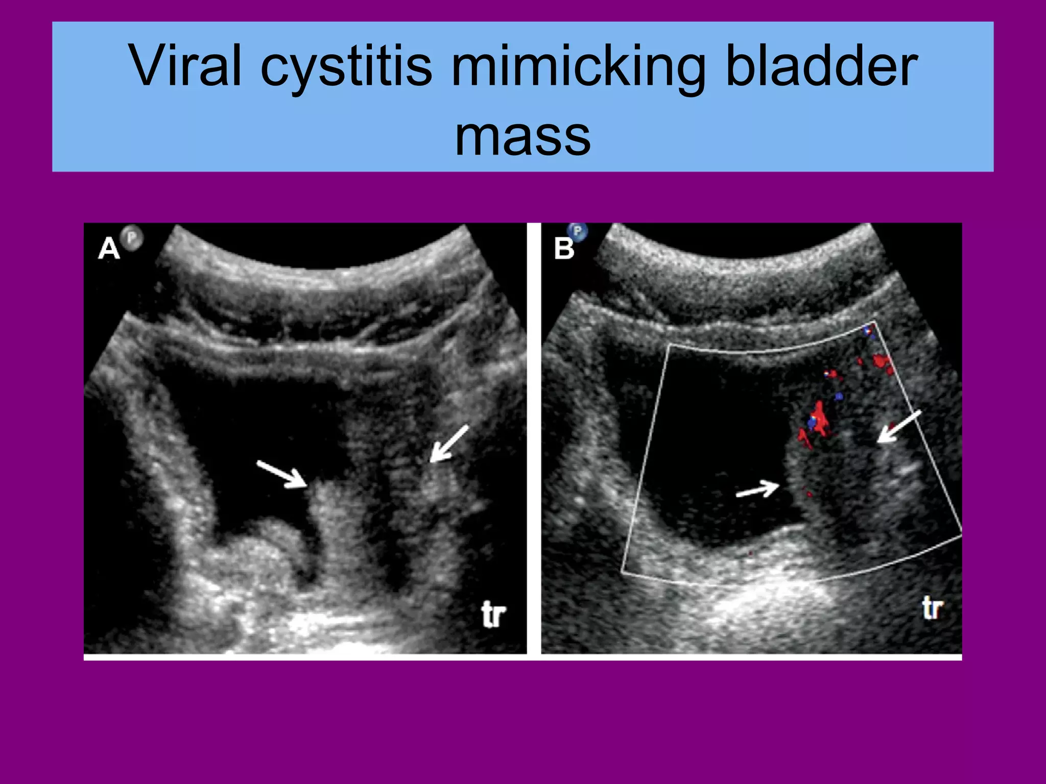 Pediatric urinary tract infection..the role of imaging | PPT