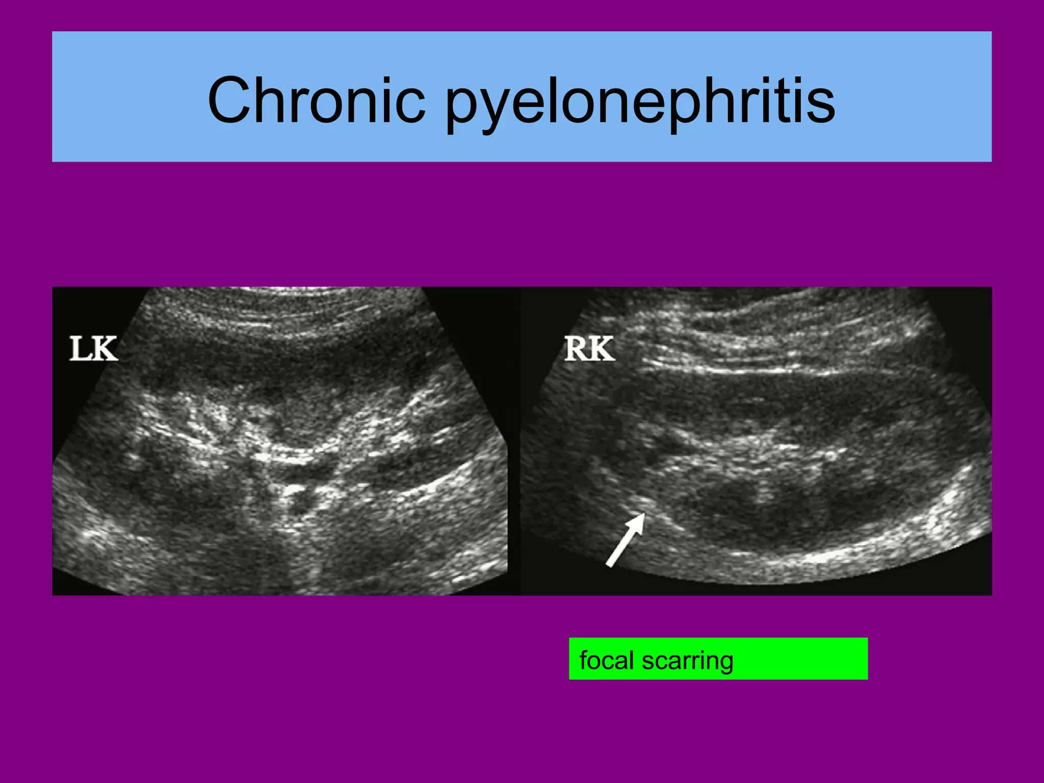 Pediatric urinary tract infection..the role of imaging | PPT