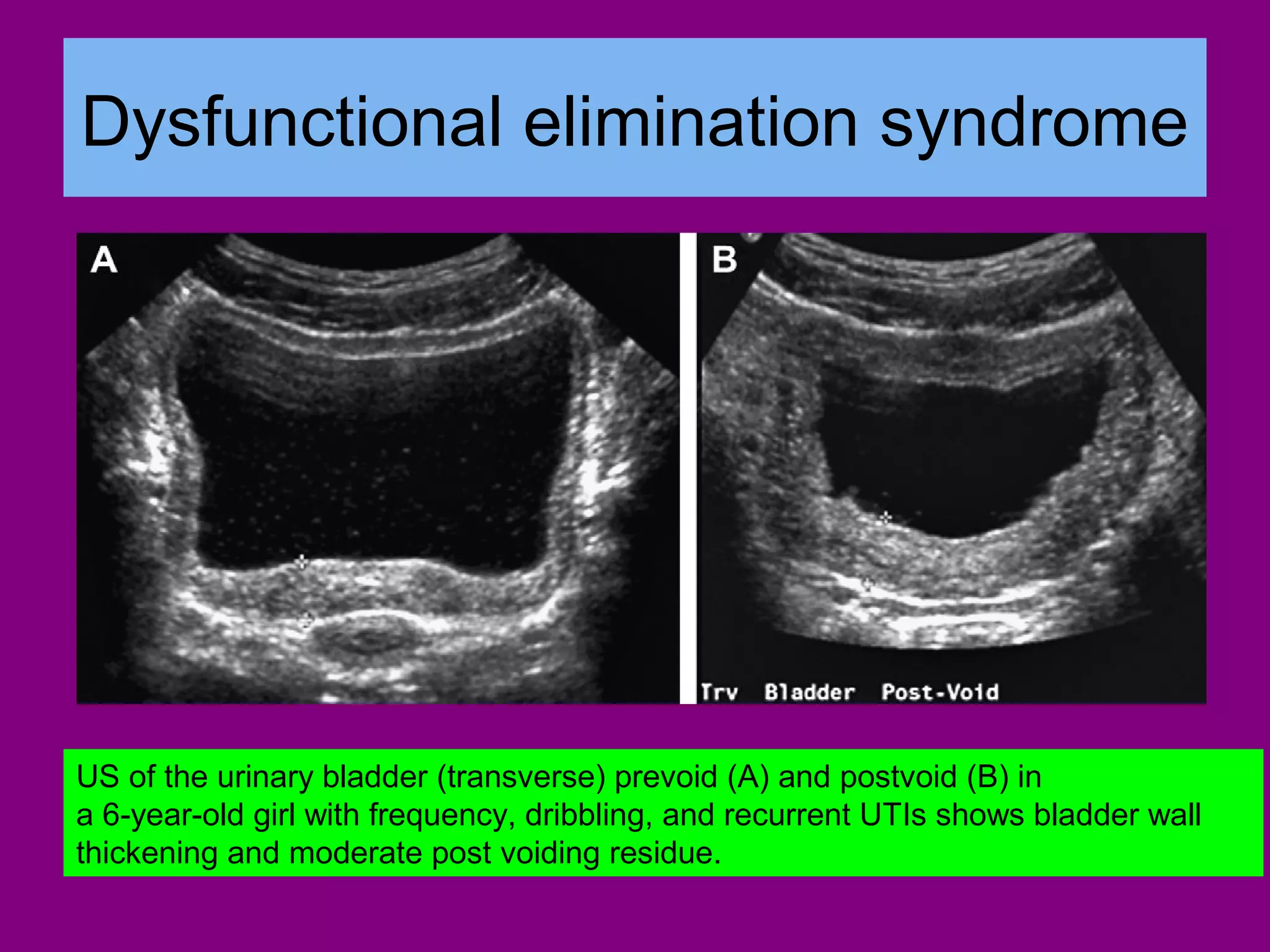 Pediatric urinary tract infection..the role of imaging | PPT