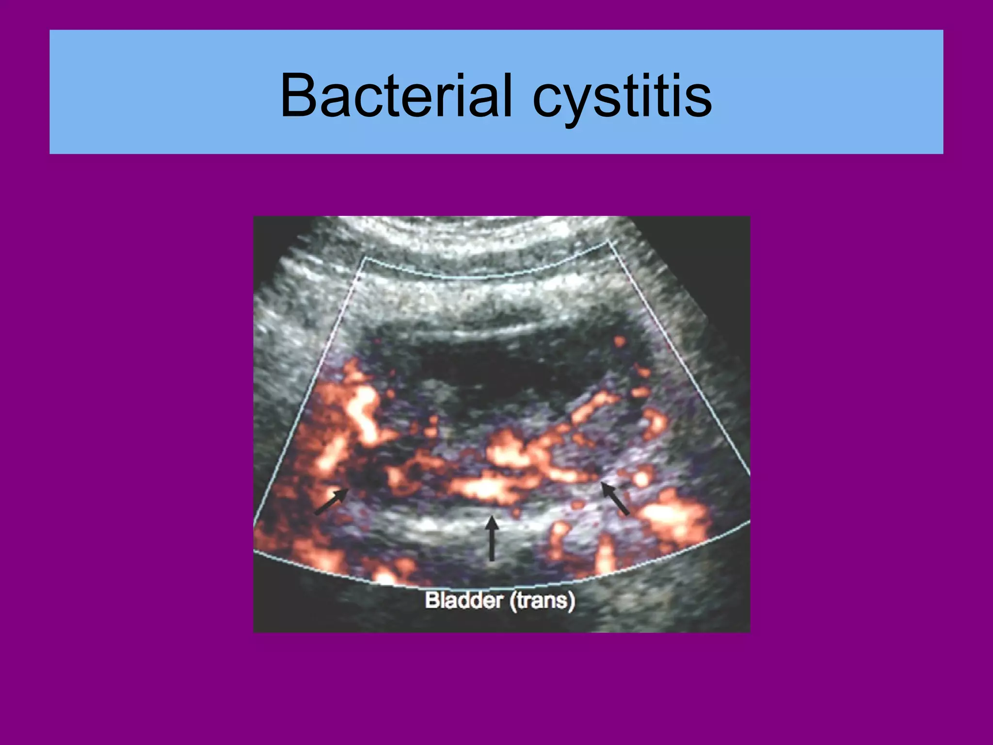 Pediatric urinary tract infection..the role of imaging | PPT