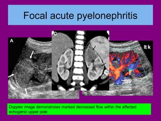 Pediatric urinary tract infection..the role of imaging | PPT