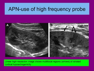 Pediatric urinary tract infection..the role of imaging | PPT