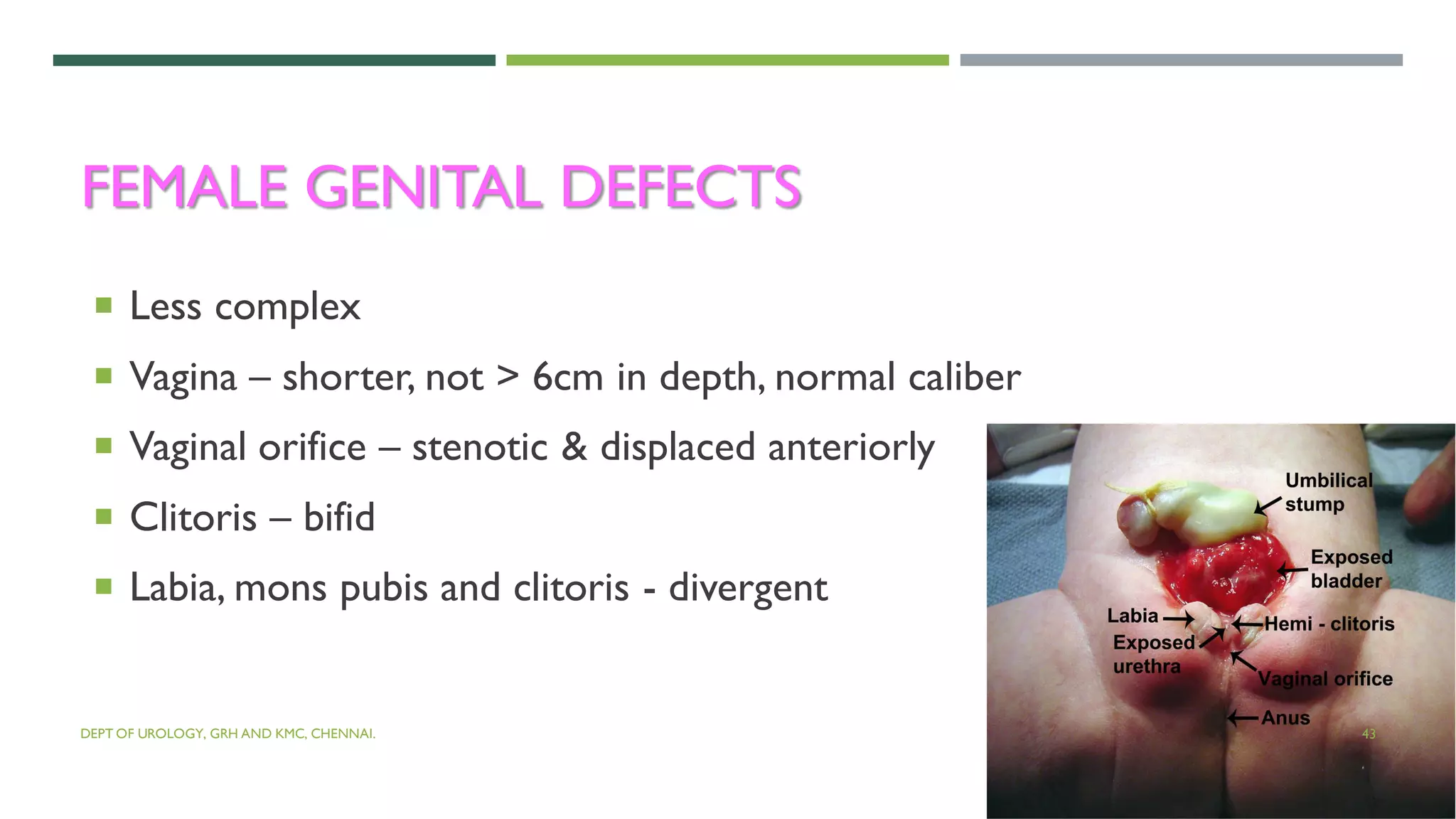 Pediatric urology:Bladder extrophy and Epispadias complex | PDF
