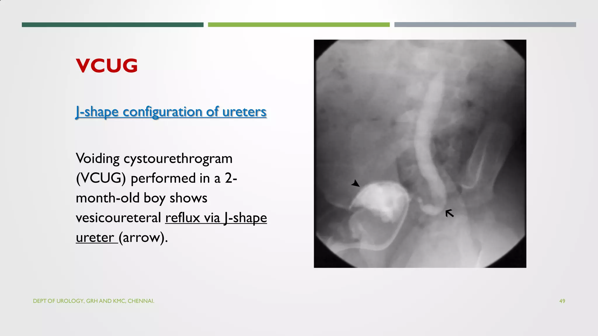 Pediatric urology:Bladder extrophy and Epispadias complex | PDF