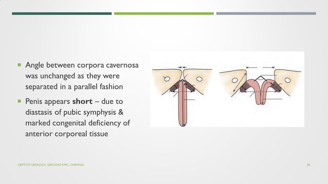Pediatric urology:Bladder extrophy and Epispadias complex | PDF ...