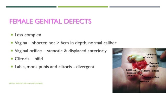Pediatric urology:Bladder extrophy and Epispadias complex | PDF ...