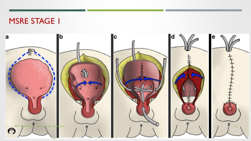Pediatric urology:Bladder extrophy and Epispadias complex