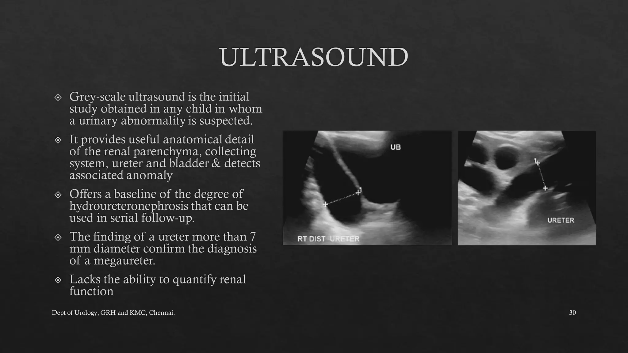 Pediatric urology:Congenital megaureter | PDF