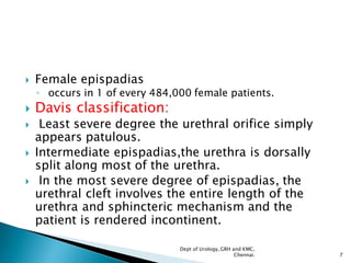Pediatric urology:Epispadias cloacal exstrophy | PDF