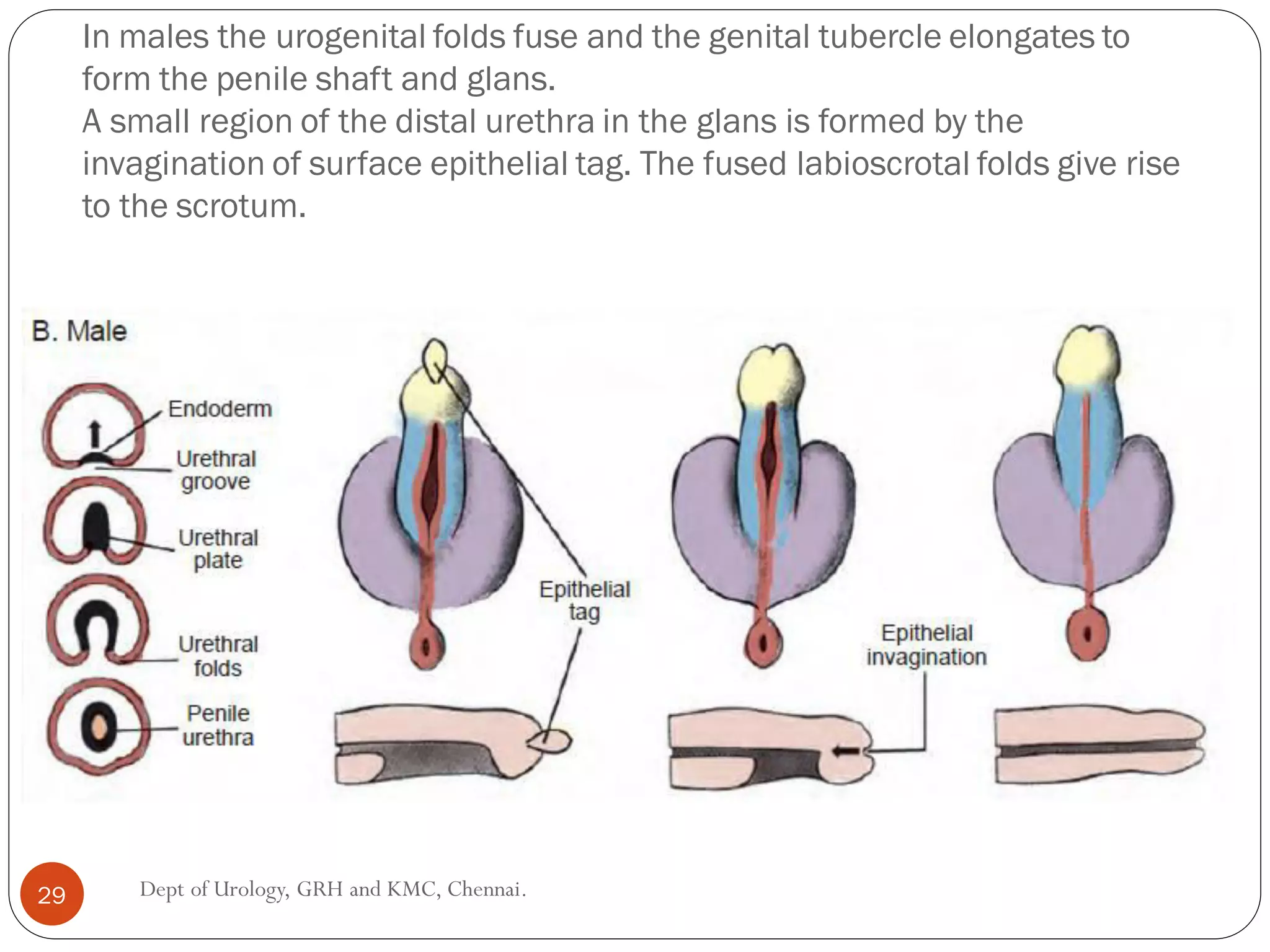 Pediatric urology:Hypospadias- etiology, embryology | PDF