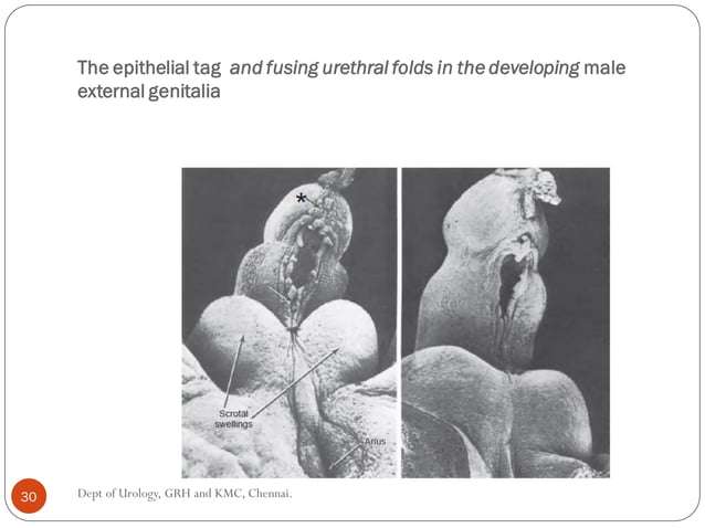 Pediatric urology:Hypospadias- etiology, embryology | PPT