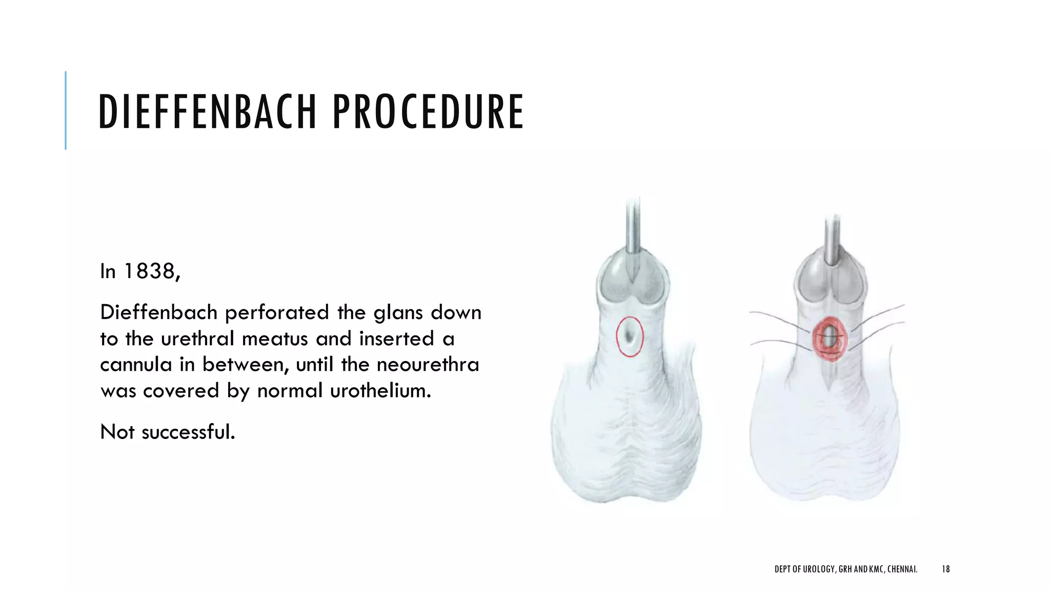 Pediatric urology:Hypospadias- management | PDF