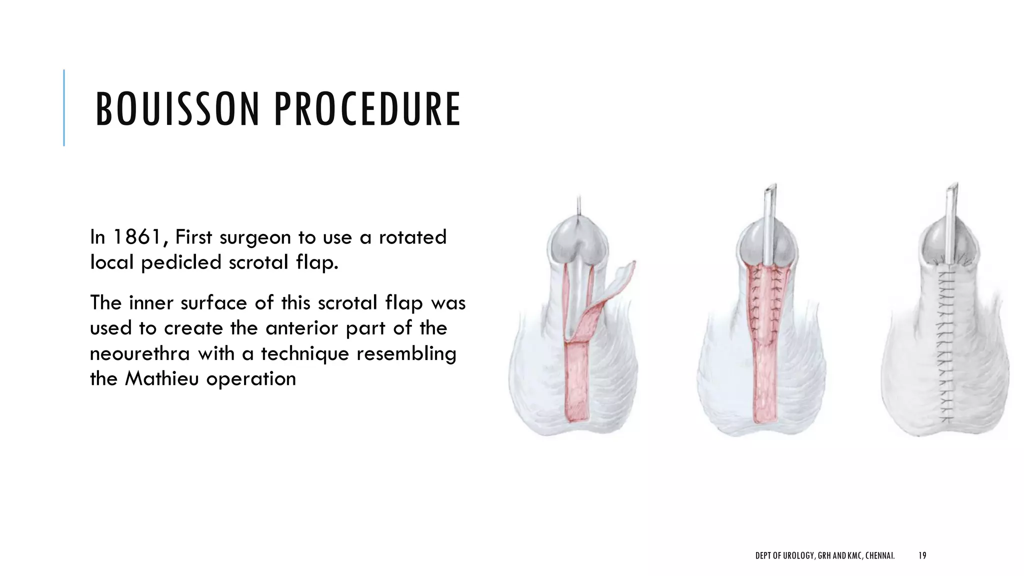 Pediatric urology:Hypospadias- management | PDF
