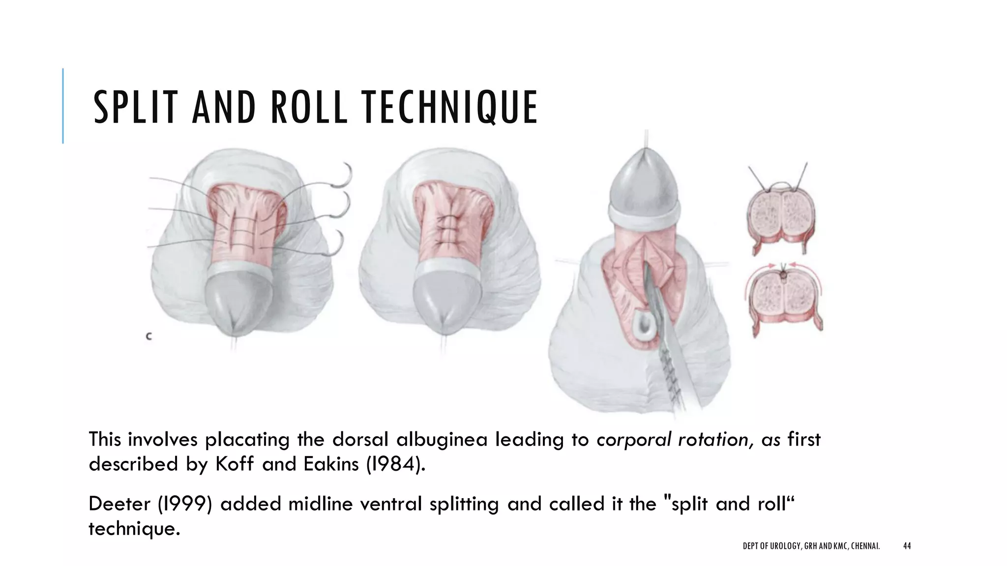 Pediatric urology:Hypospadias- management | PDF