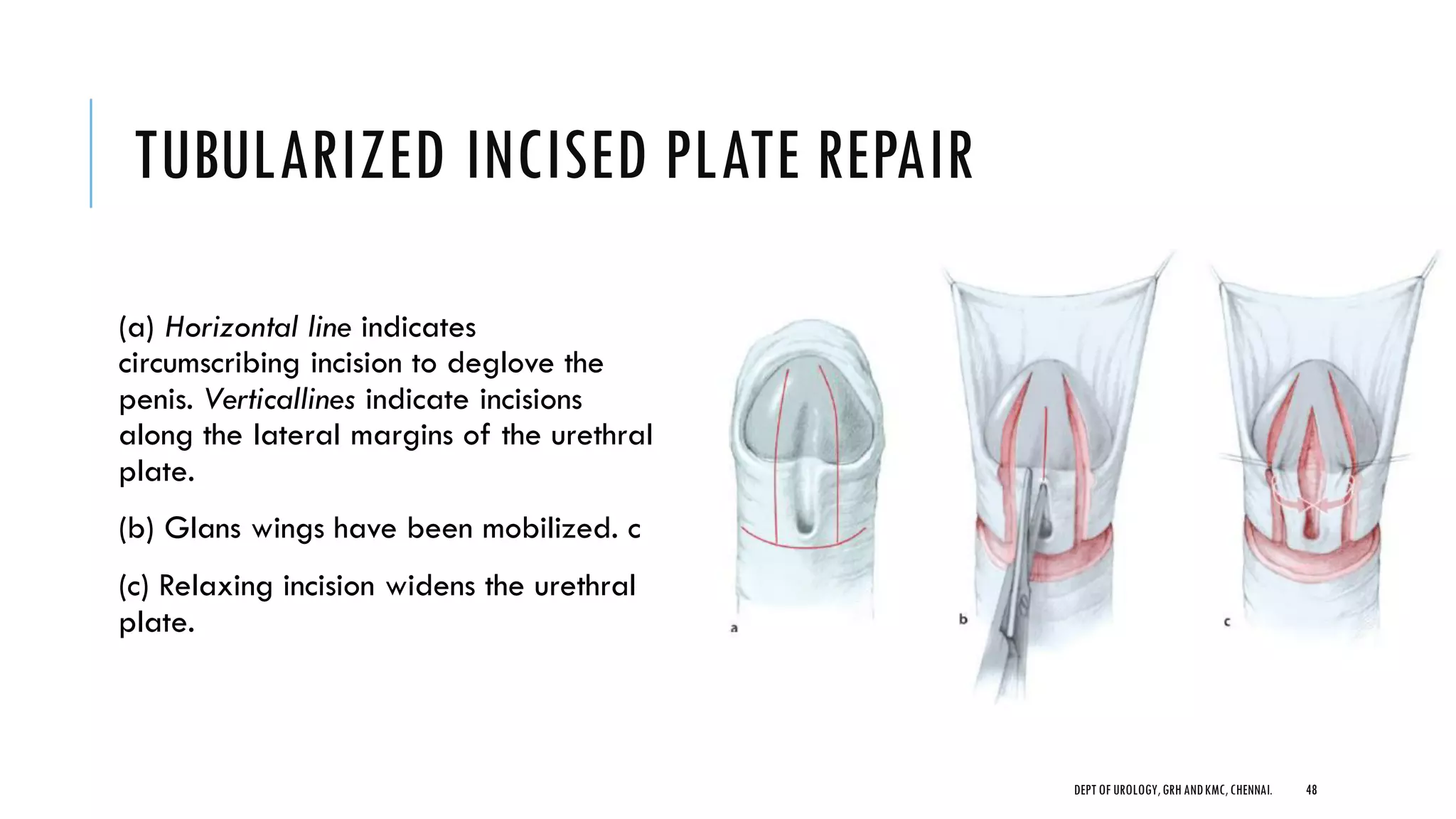 Pediatric urology:Hypospadias- management | PDF