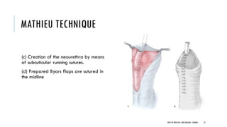 Pediatric urology:Hypospadias- management | PDF