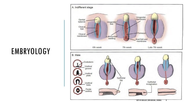 Pediatric urology:Hypospadias- management | PDF