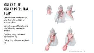 Pediatric urology:Hypospadias- management | PDF