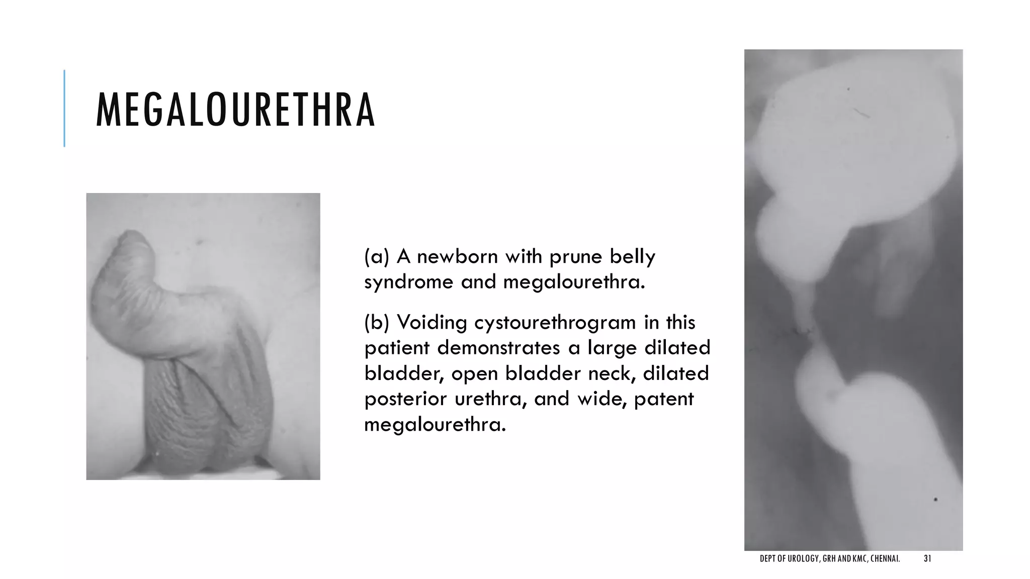 Pediatric urology:Prune Belly Syndrome(PBS) | PDF