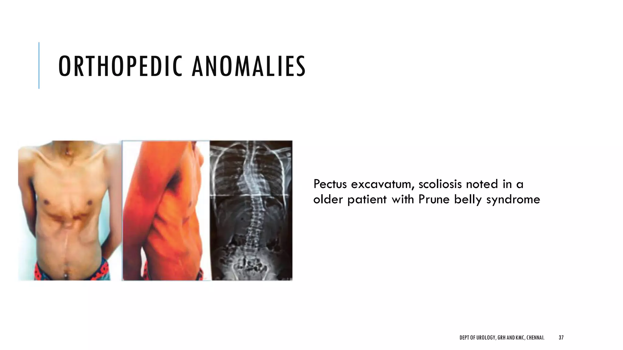 Pediatric urology:Prune Belly Syndrome(PBS) | PDF