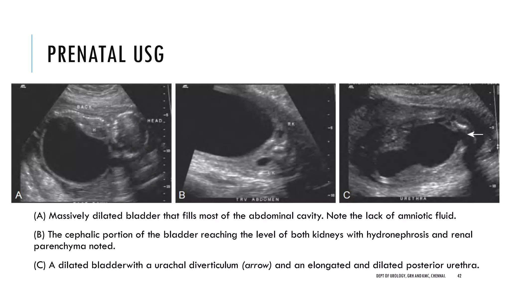 Pediatric urology:Prune Belly Syndrome(PBS) | PDF