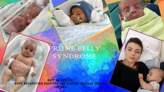 Pediatric urology:Prune Belly Syndrome(PBS) | PDF