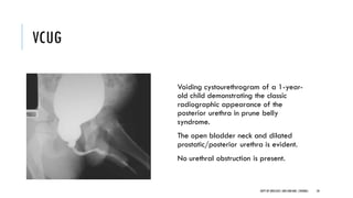 Pediatric urology:Prune Belly Syndrome(PBS) | PDF