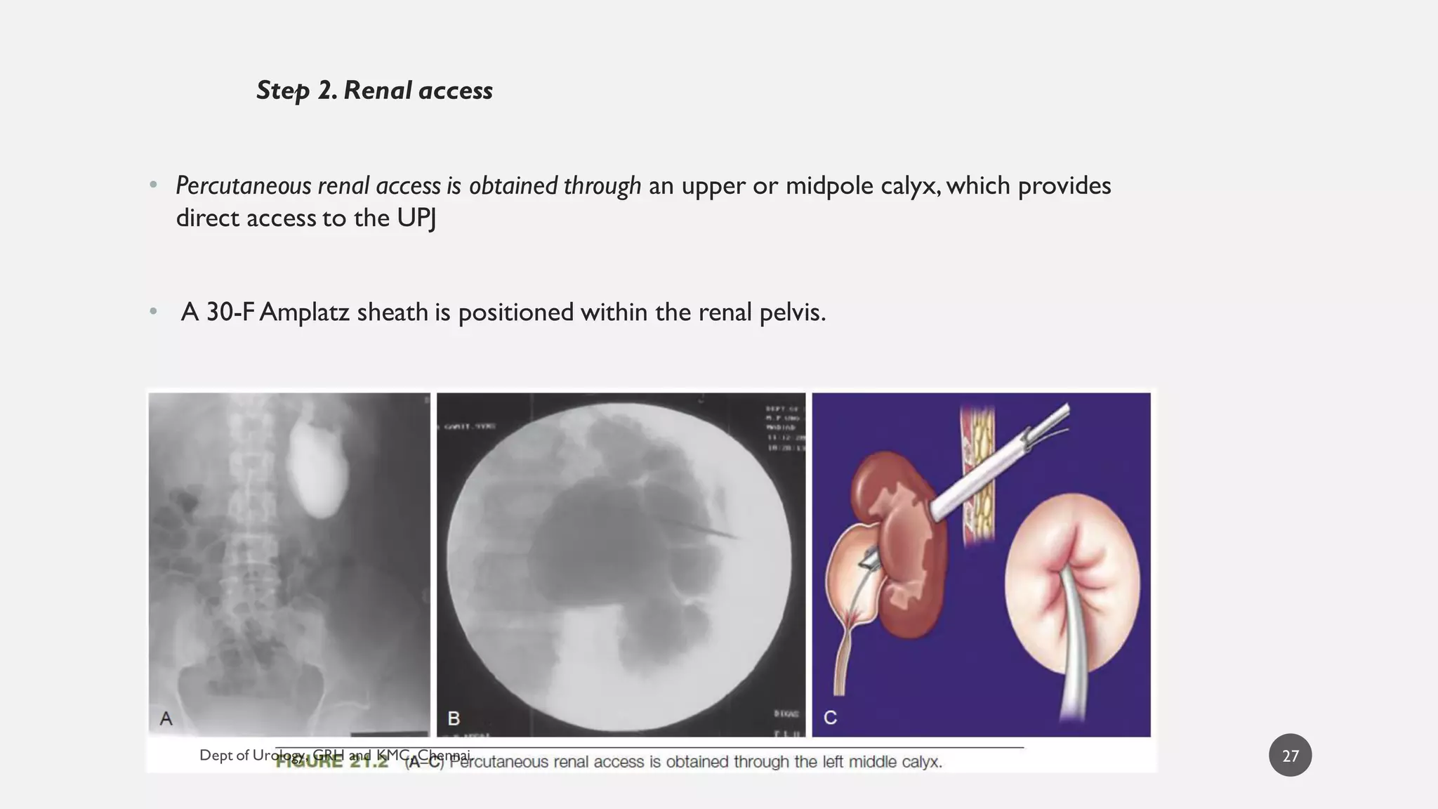 Pediatric urology:Pujo- endopyelotomy | PPT