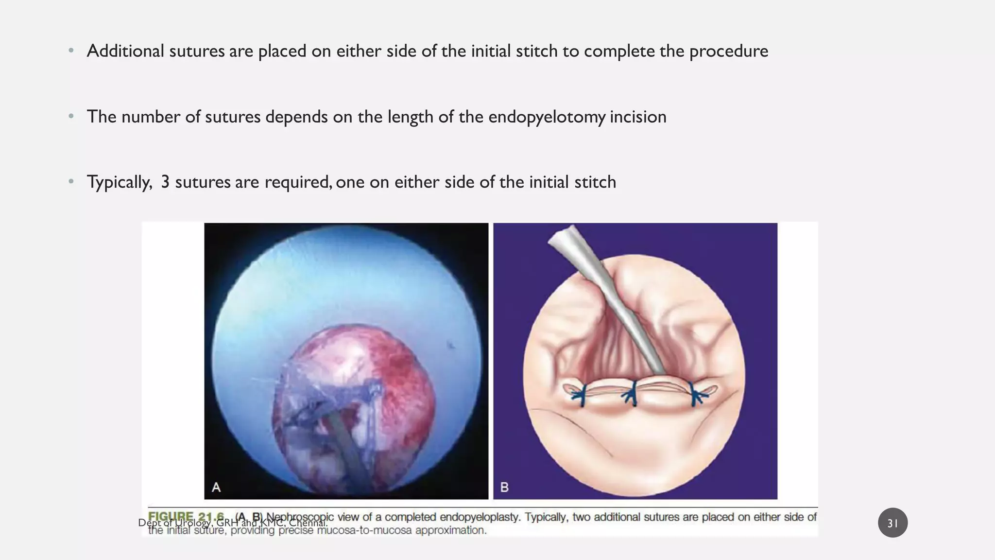 Pediatric urology:Pujo- endopyelotomy | PPT