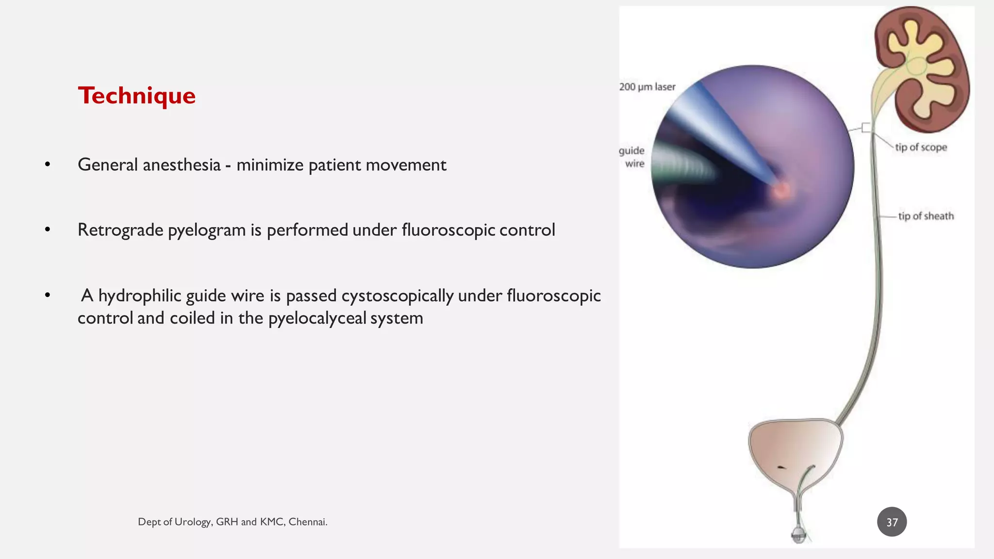 Pediatric urology:Pujo- endopyelotomy | PPT