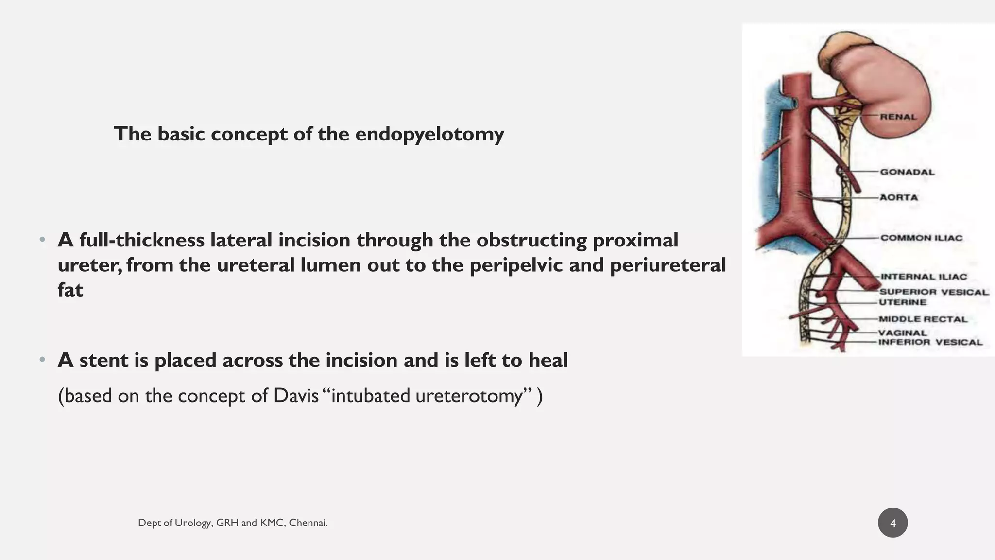 Pediatric urology:Pujo- endopyelotomy | PPT