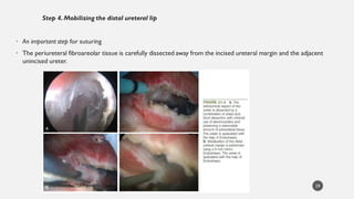 Pediatric urology:Pujo- endopyelotomy | PDF