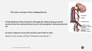 Pediatric urology:Pujo- endopyelotomy | PPT