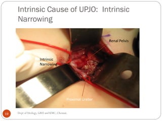 Pediatric urology:Pujo- etiopathogenesis and presentation | PDF