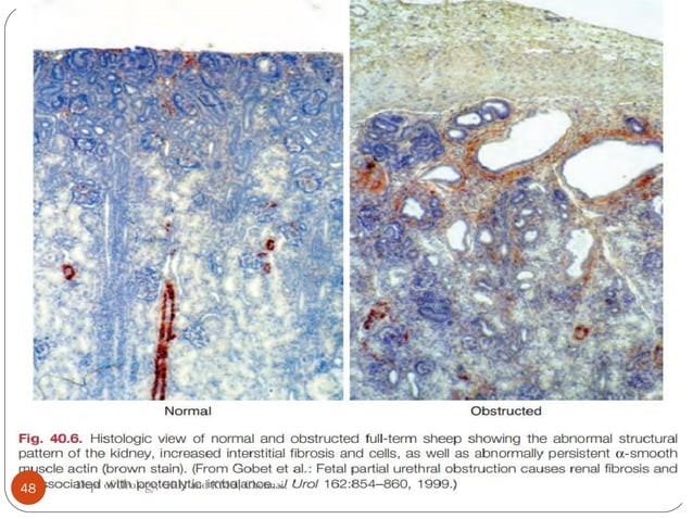 Pediatric urology:Pujo- etiopathogenesis and presentation | PDF