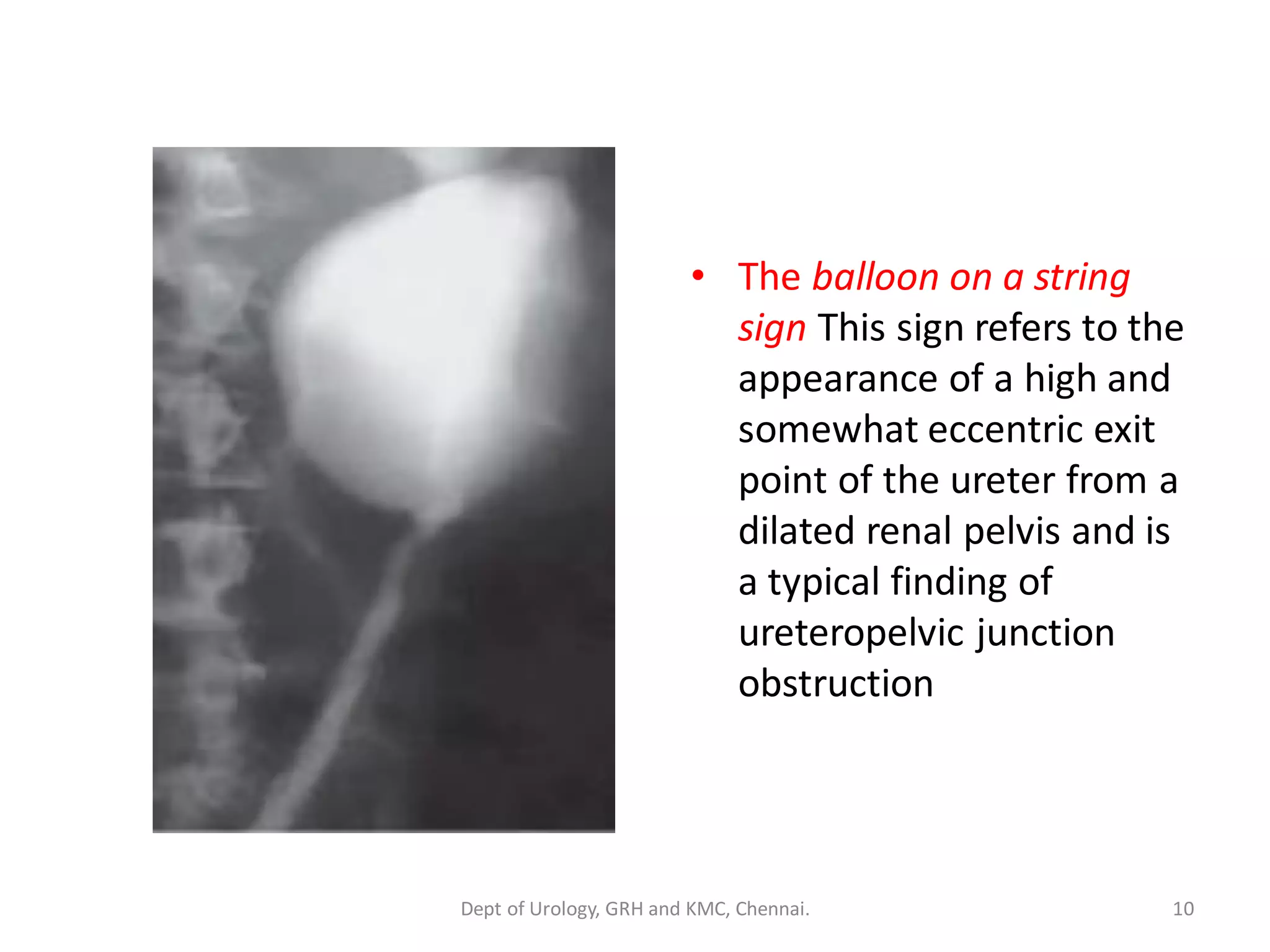 Pediatric urology:Role of ivu, usg in Pelvi-Ureteric Junction ...