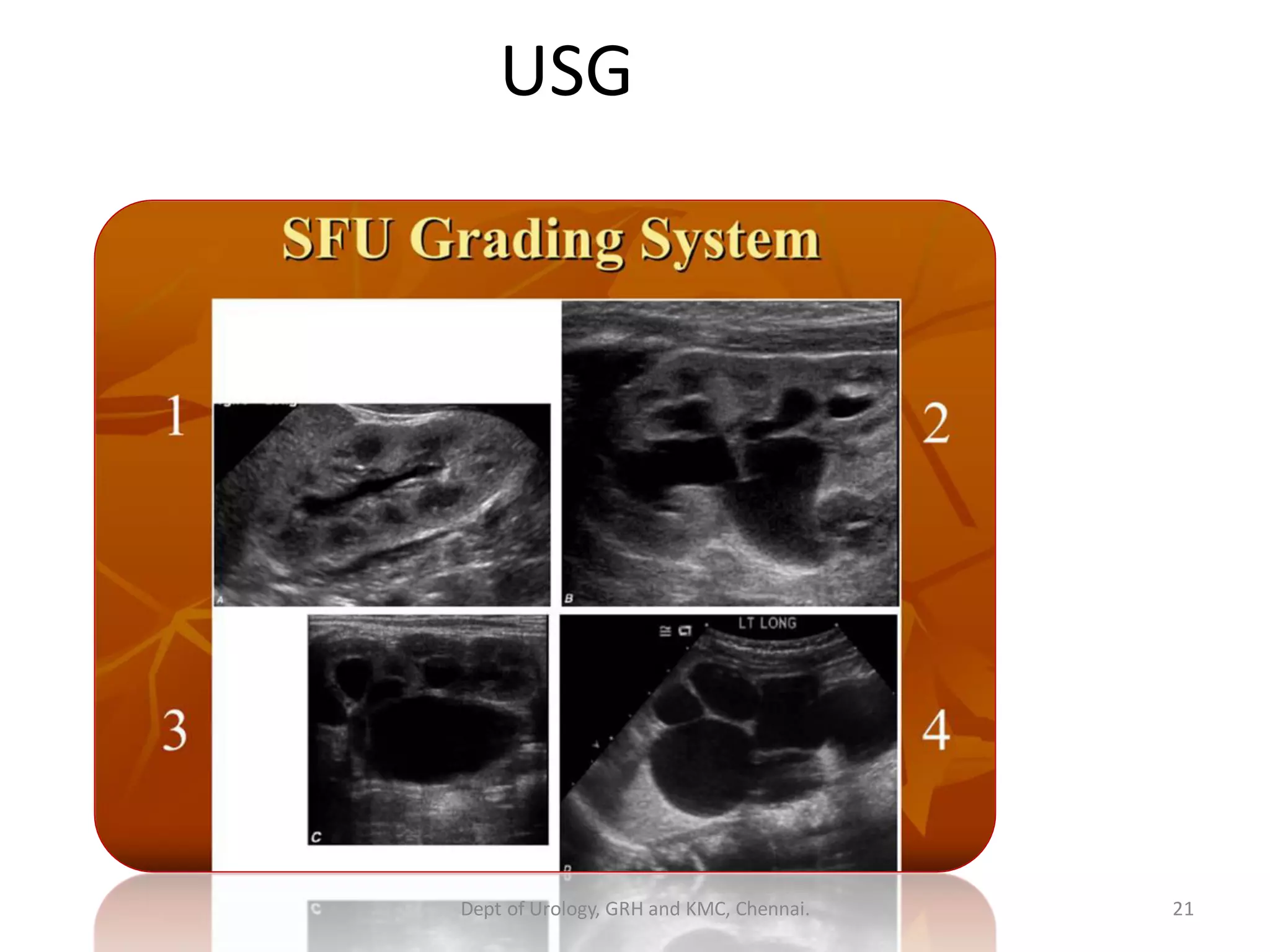 Pediatric urology:Role of ivu, usg in Pelvi-Ureteric Junction ...