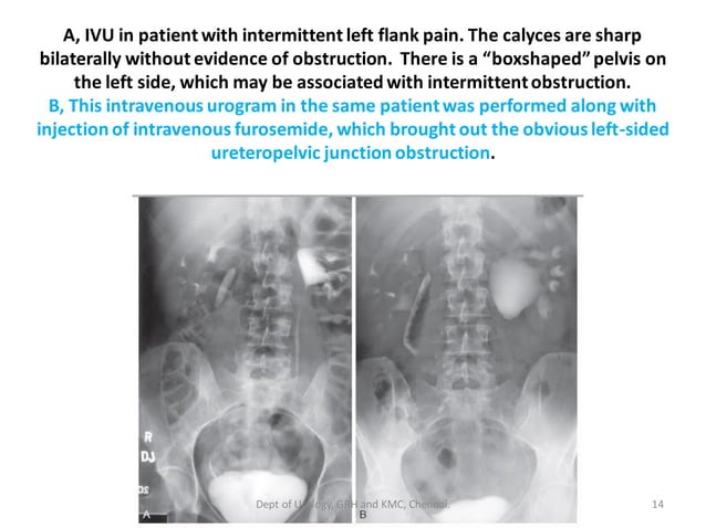 Pediatric Urology Role Of Ivu Usg In Pelvi Ureteric Junction