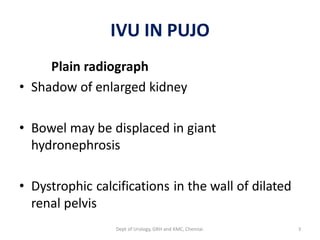 Pediatric urology:Role of ivu, usg in Pelvi-Ureteric Junction ...