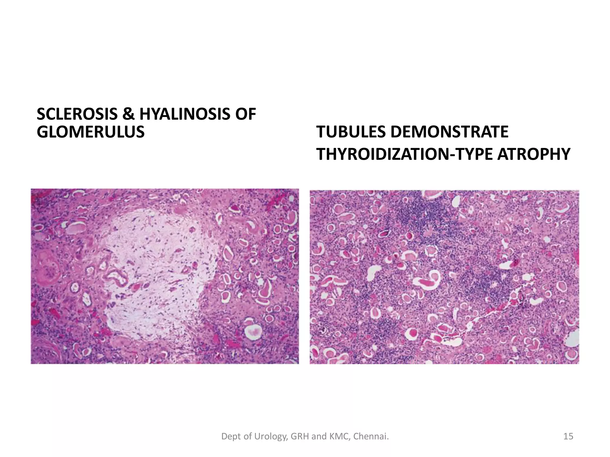 Pediatric urology pujo- pathology | PDF