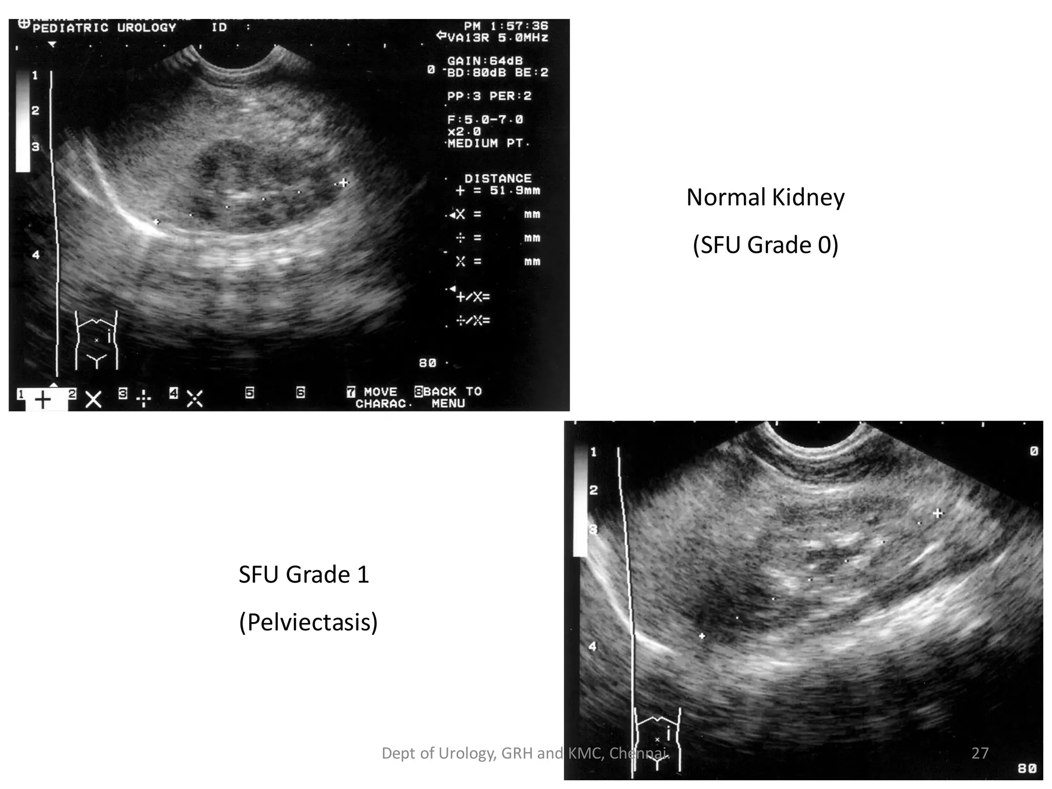 Pediatric urology pujo- pathology | PDF