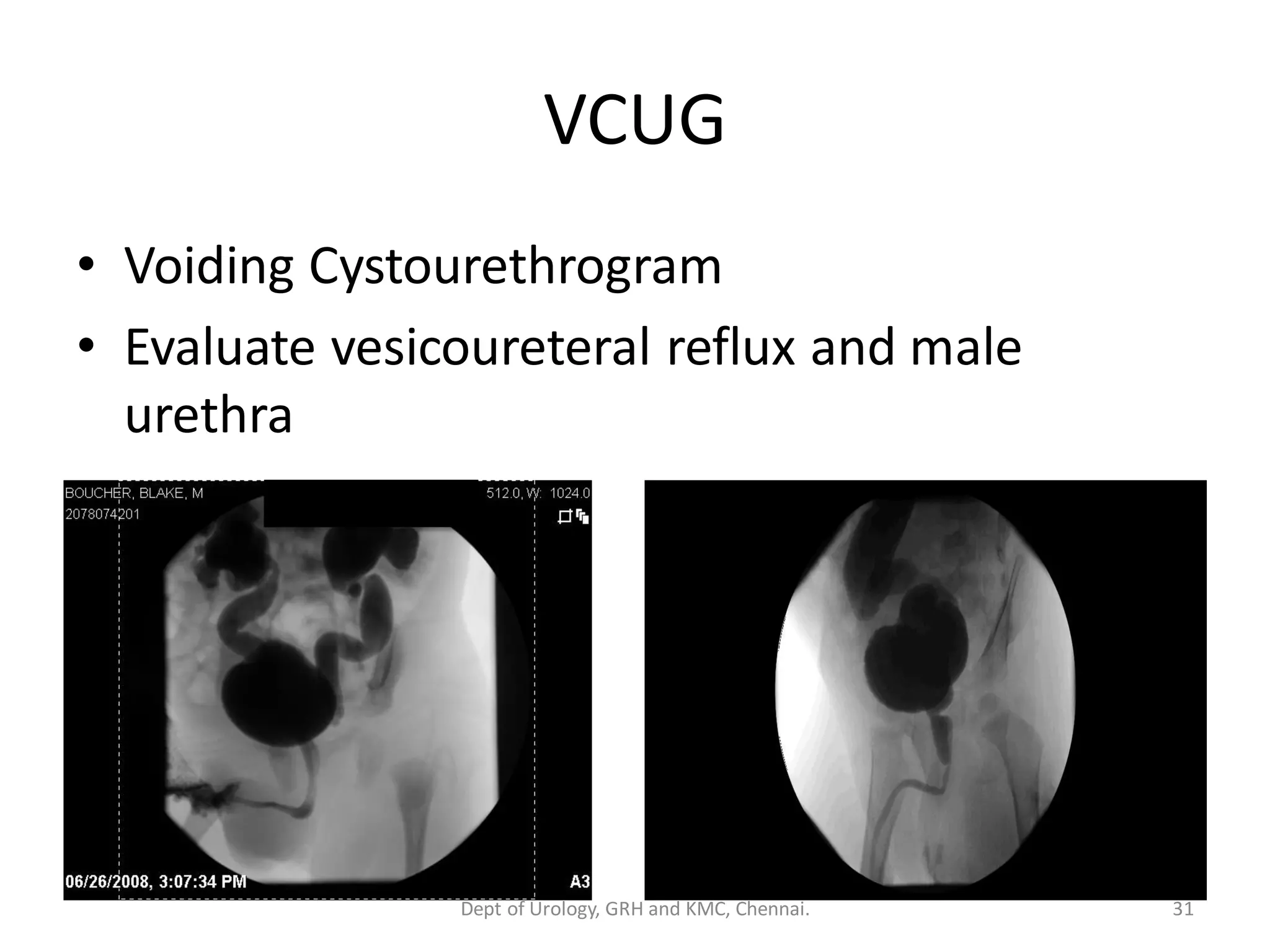Pediatric urology pujo- pathology | PDF