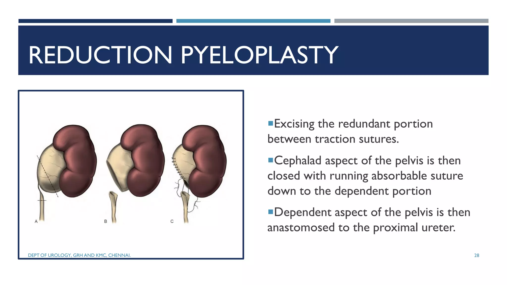 Pediatric urology pujo- pyeloplasty | PDF