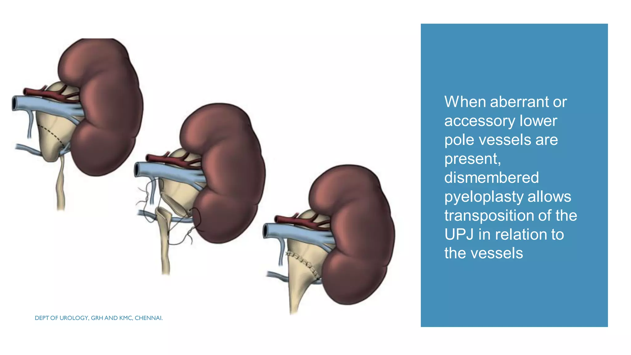 Pediatric urology pujo- pyeloplasty | PDF