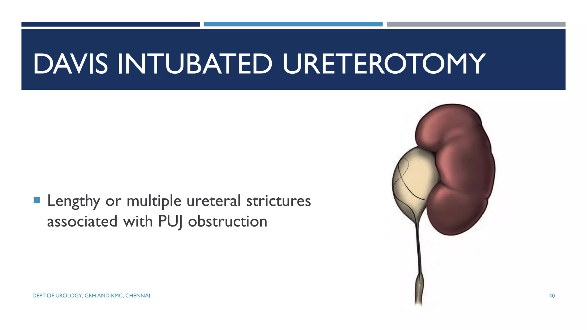 Pediatric urology pujo- pyeloplasty | PDF