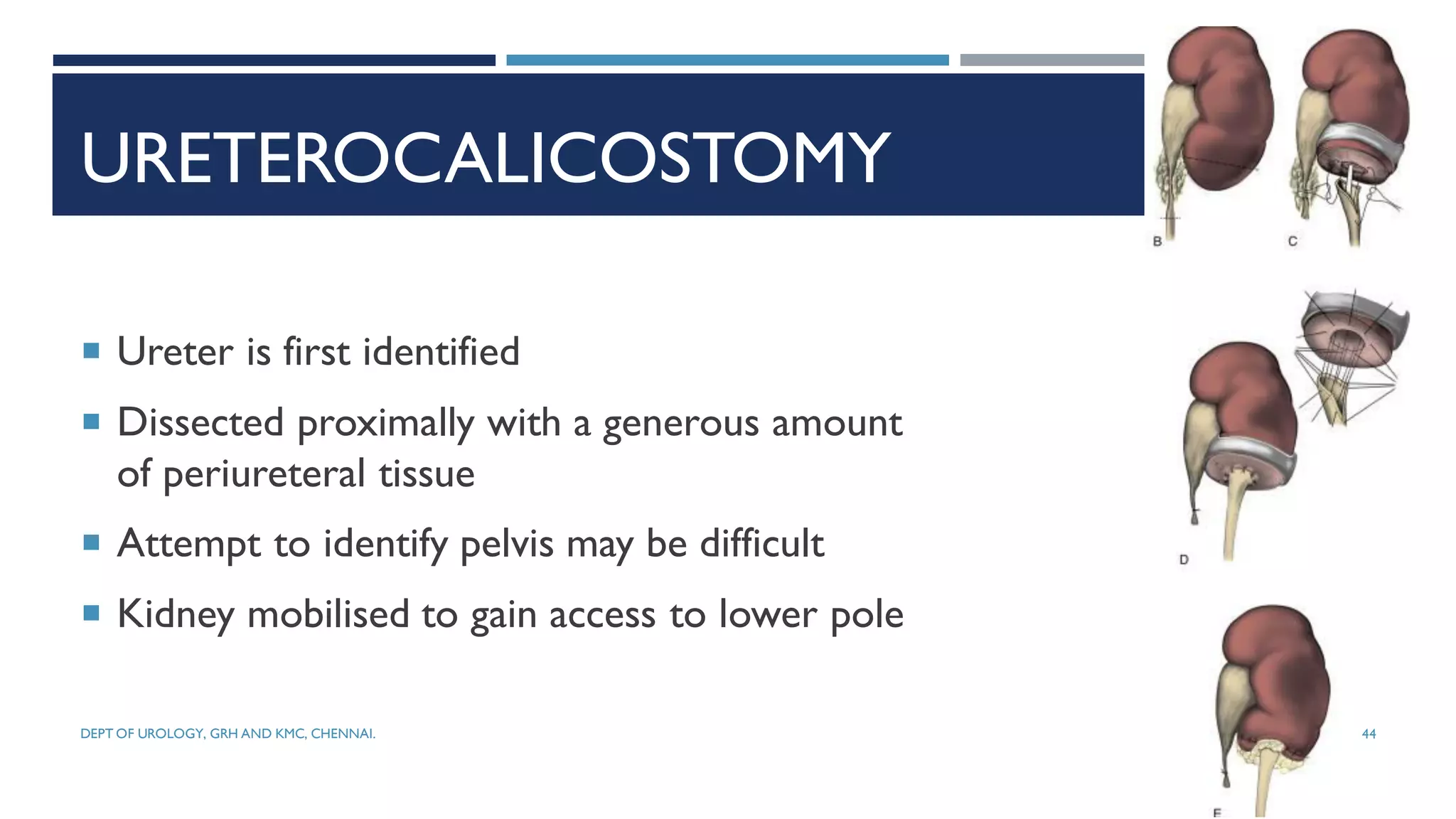 Pediatric urology pujo- pyeloplasty | PDF