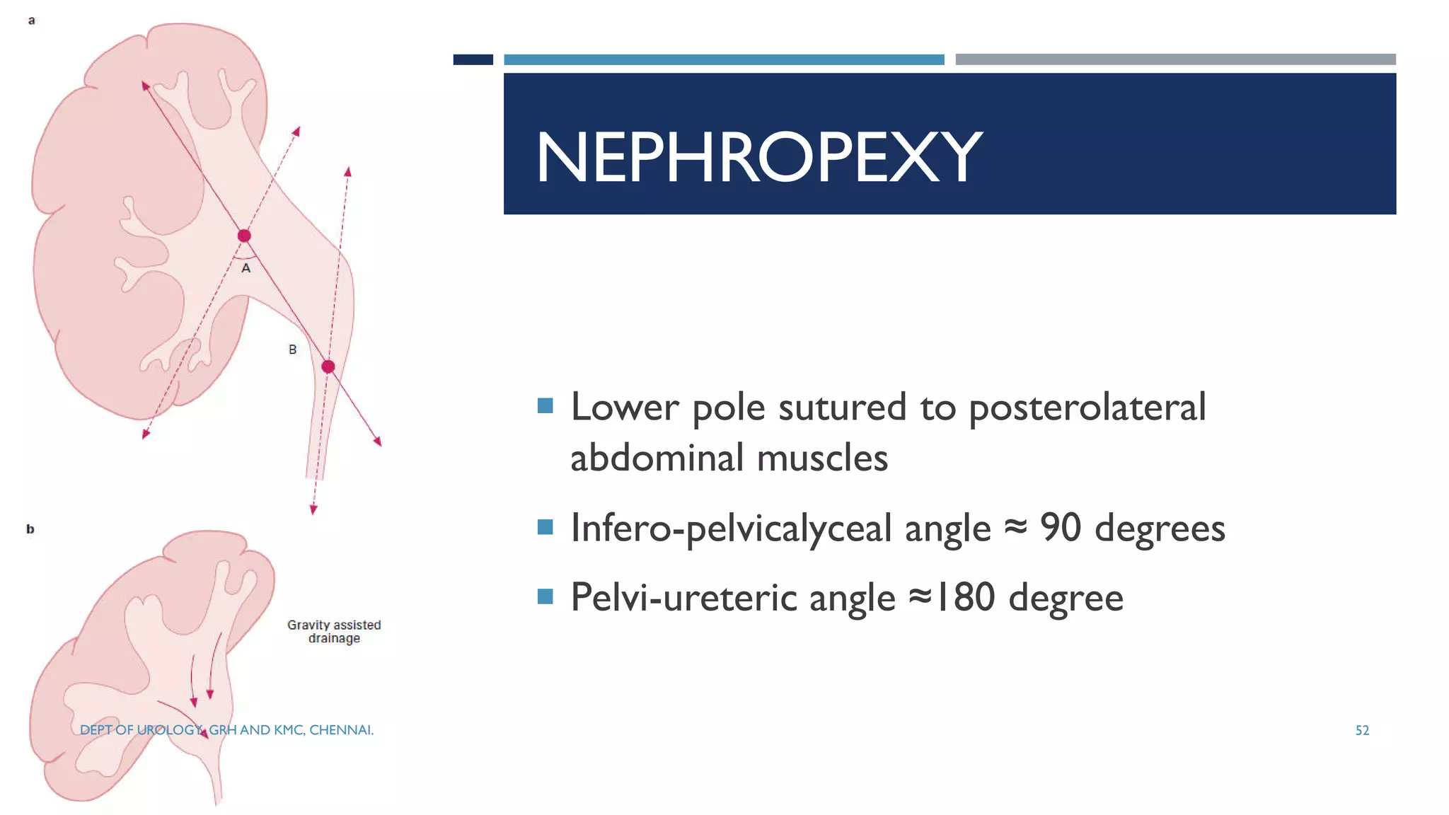 Pediatric urology pujo- pyeloplasty | PDF