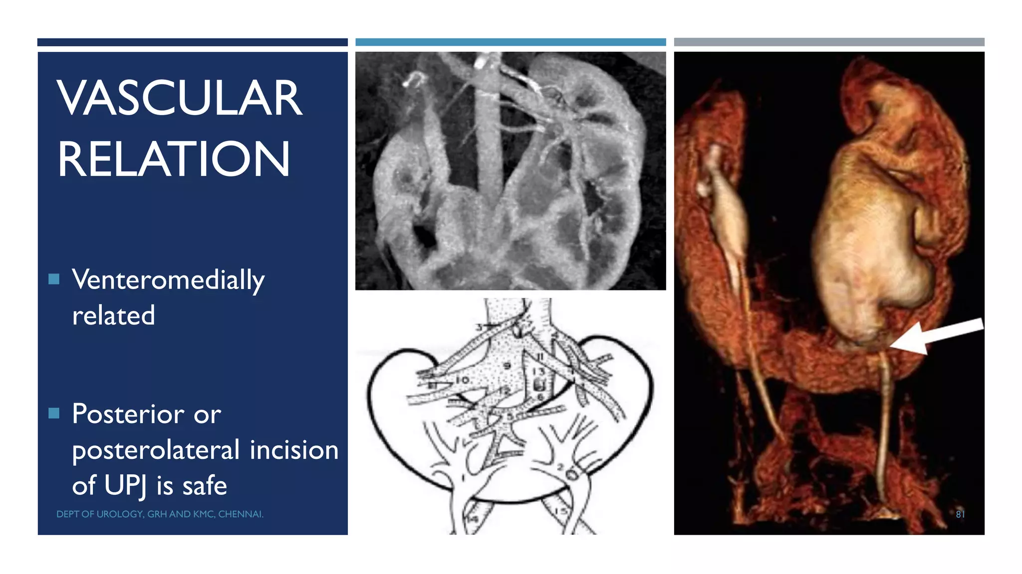 Pediatric urology pujo- pyeloplasty | PDF