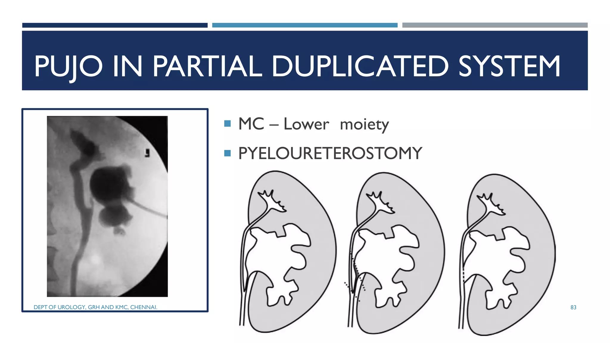 Pediatric urology pujo- pyeloplasty | PDF