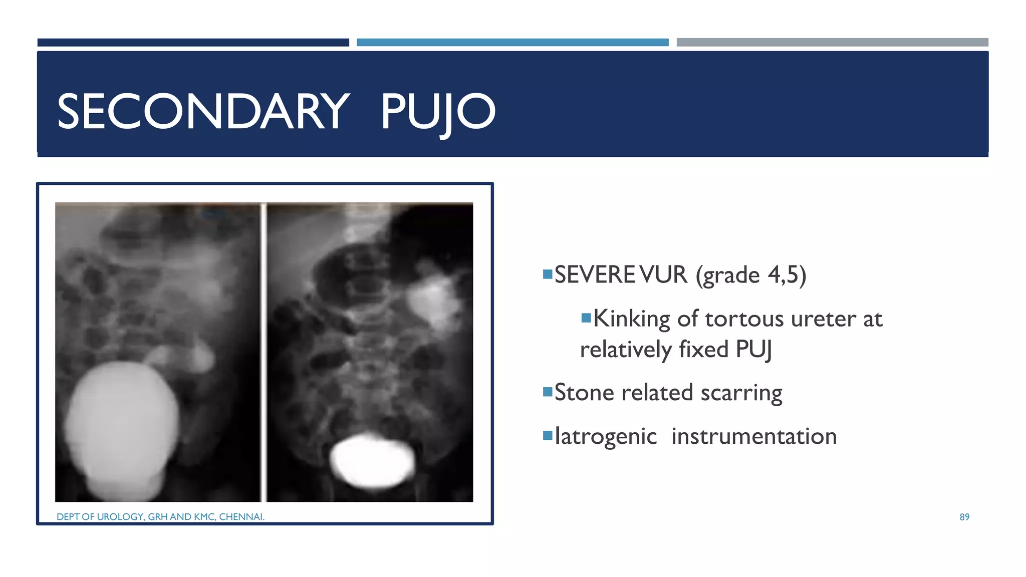 Pediatric urology pujo- pyeloplasty | PDF